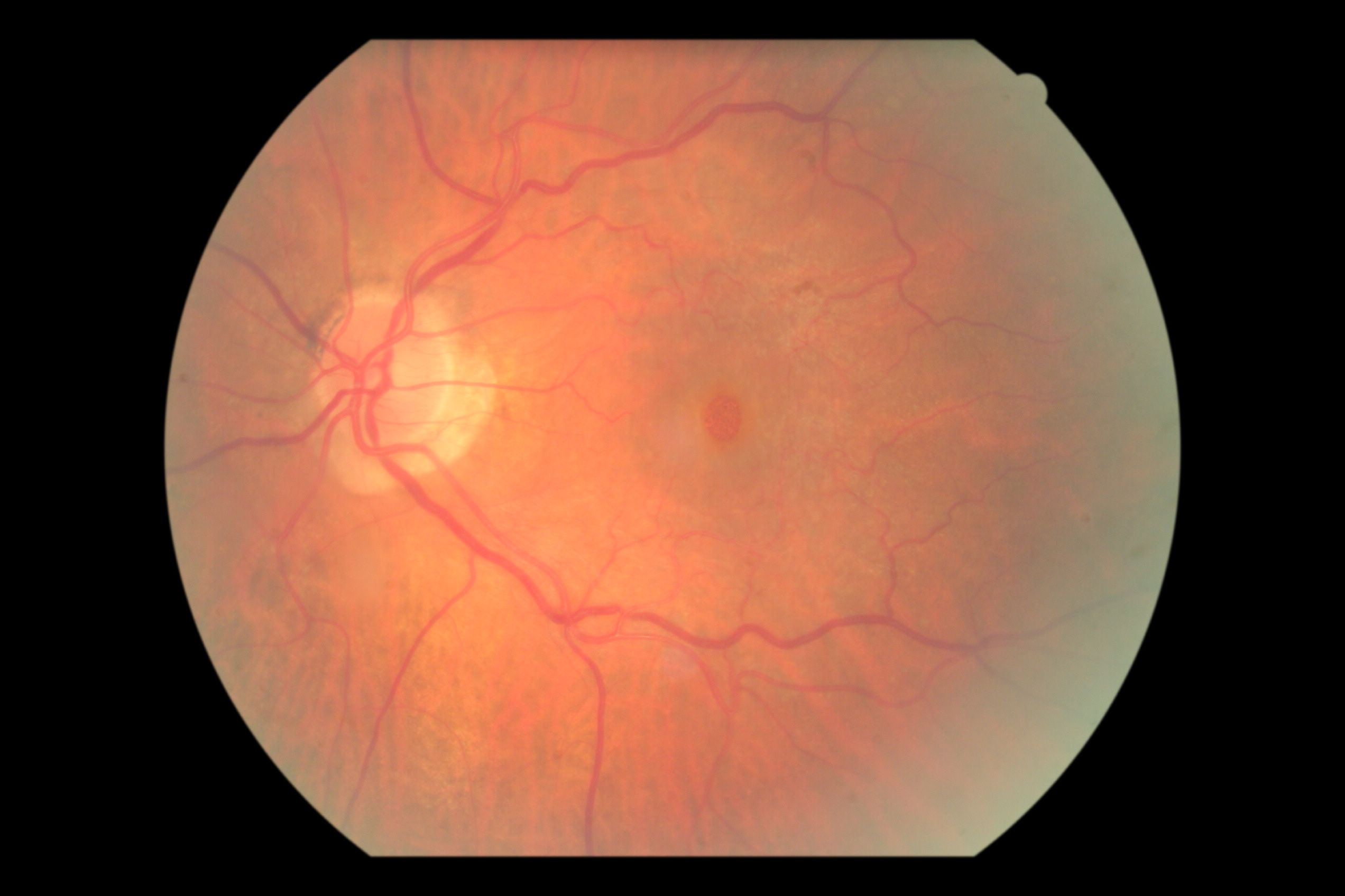 TROU MACULAIRE - Sevision