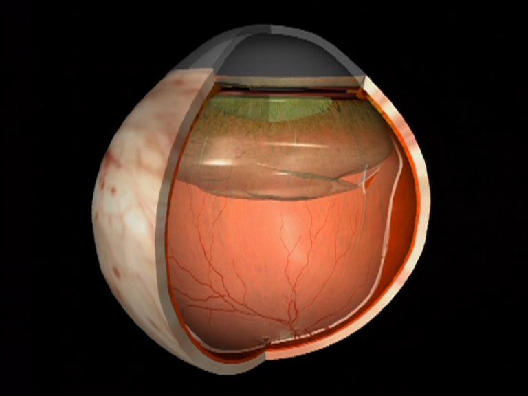 DECOLLEMENT DE RETINE - Sevision